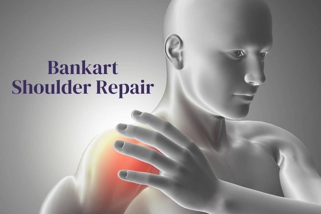 Restore Stability with Expert Surgery for Bankart Shoulder Repair