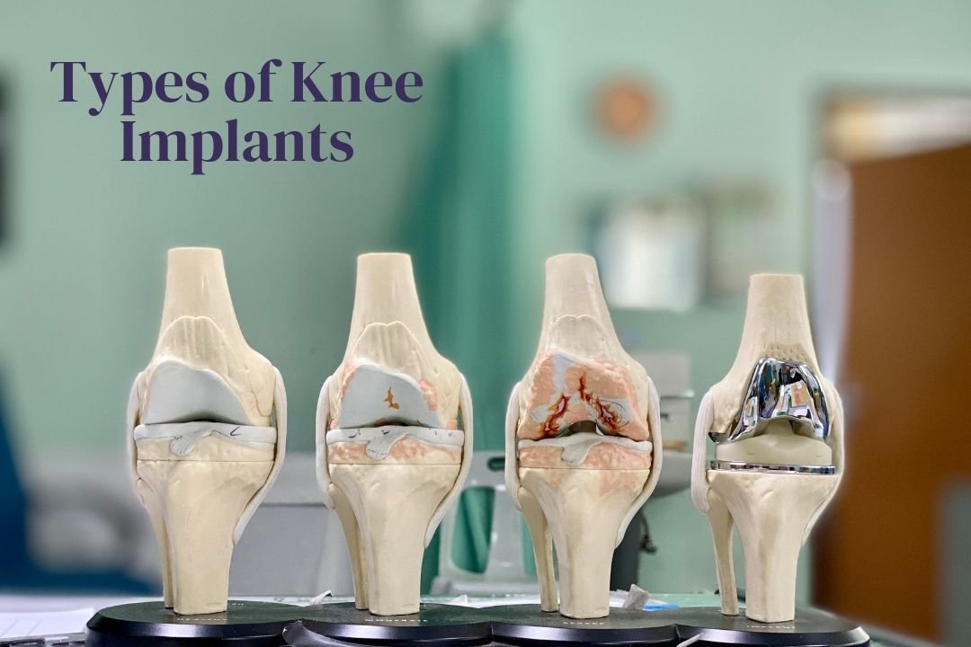 Learn more about Types, Designs, and Factors for Knee Implants