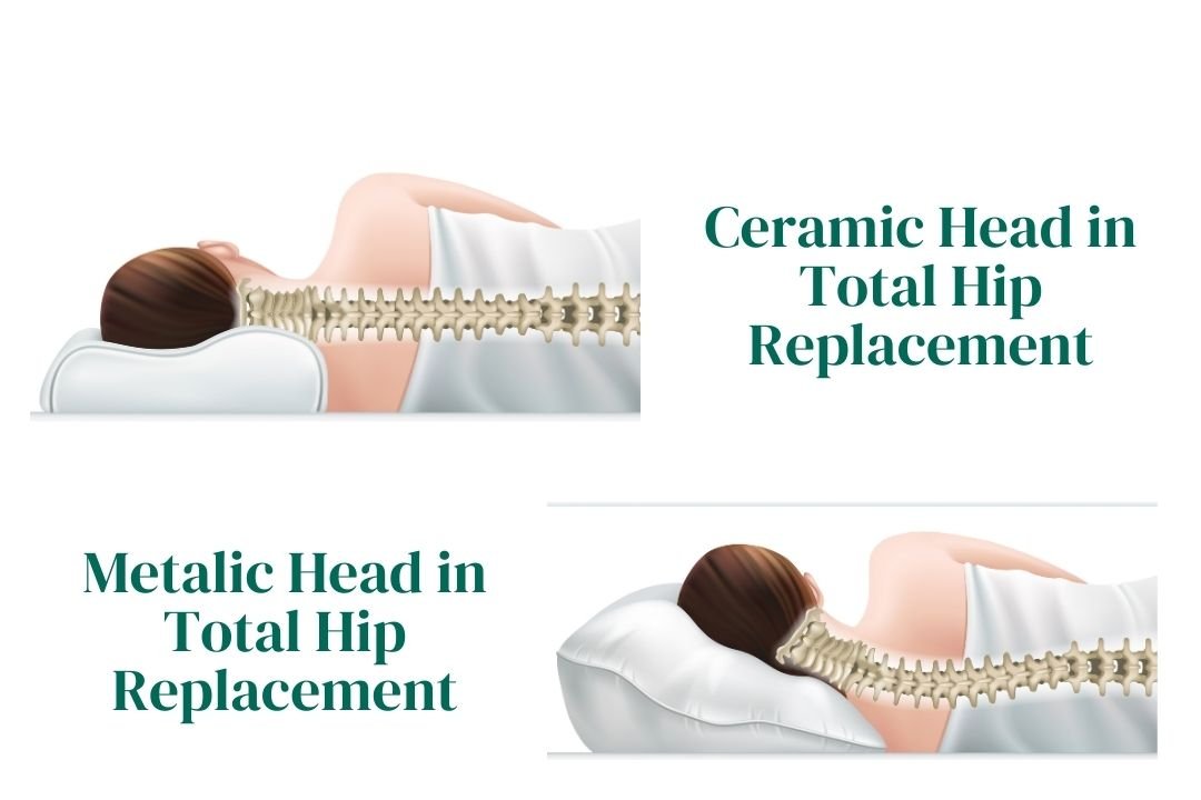 Understanding the Differences between Ceramic vs Metal Heads in Total ...